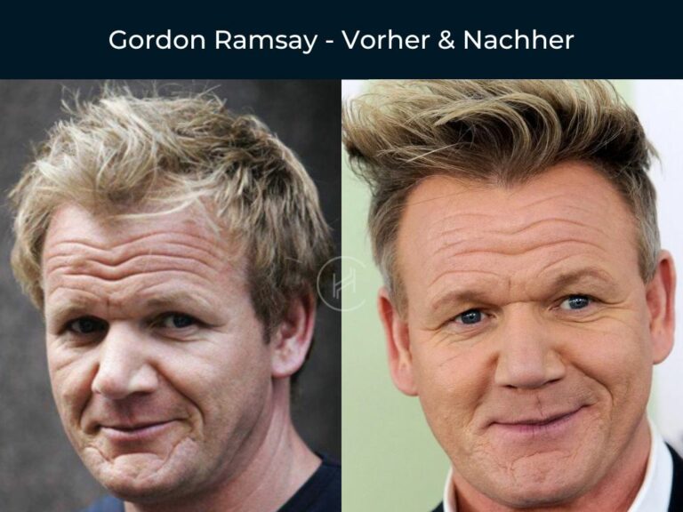 Promis Mit Haartransplantation