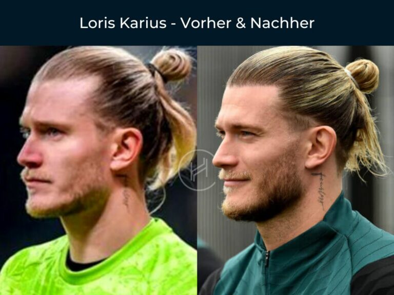43 Promis mit Haartransplantation - Vorher & Nachher - Vorher & Nachher