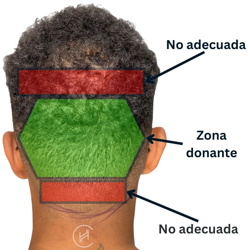 ¿Qué es la zona donante injerto capilar en un trasplante de pelo?