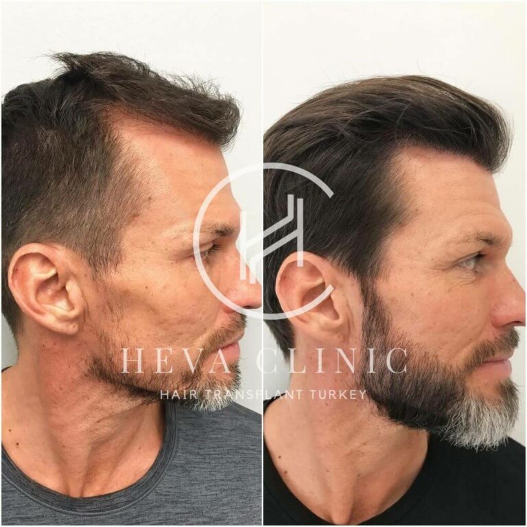 Greffe de cheveux DHI en Turquie - Prix en 2025 - Heva Clinic