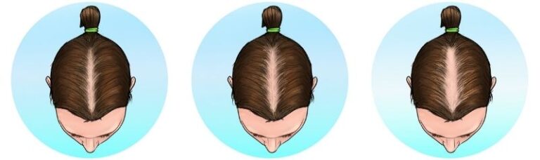 Ludwig Scale | Female Baldness Pattern - Heva Clinic