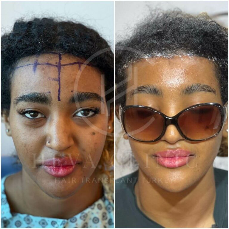 Forehead Reduction Before & After Photos - Unfiltered Results