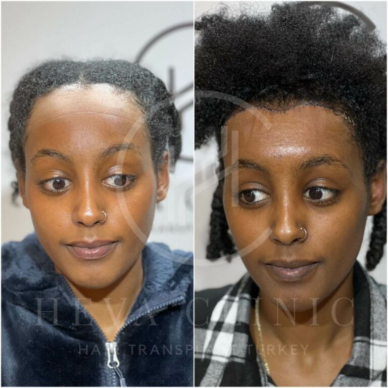 Forehead Reduction Before & After Photos - Unfiltered Results