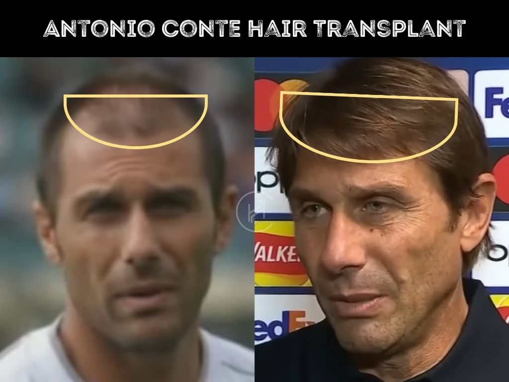 Antonio Conte Hair Transplant - Hair Loss & Technical Analysis Antonio Conte Hair Transplant - Hair Loss & Technical Analysis