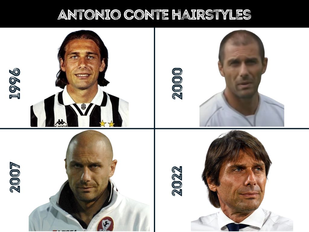 Antonio Conte Hair Transplant - Hair Loss & Technical Analysis Antonio Conte Hair Transplant - Hair Loss & Technical Analysis