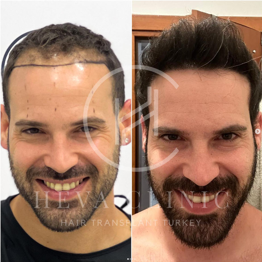 Hair Transplant Before And After 3000 Grafts Hair Transplant Before And After 3000 Grafts