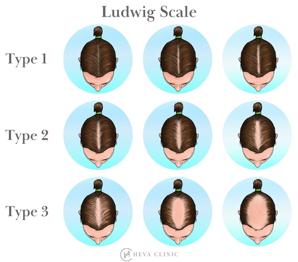 Pcos Hair Loss Treatment And Hair Transplant Best Solutions For Female