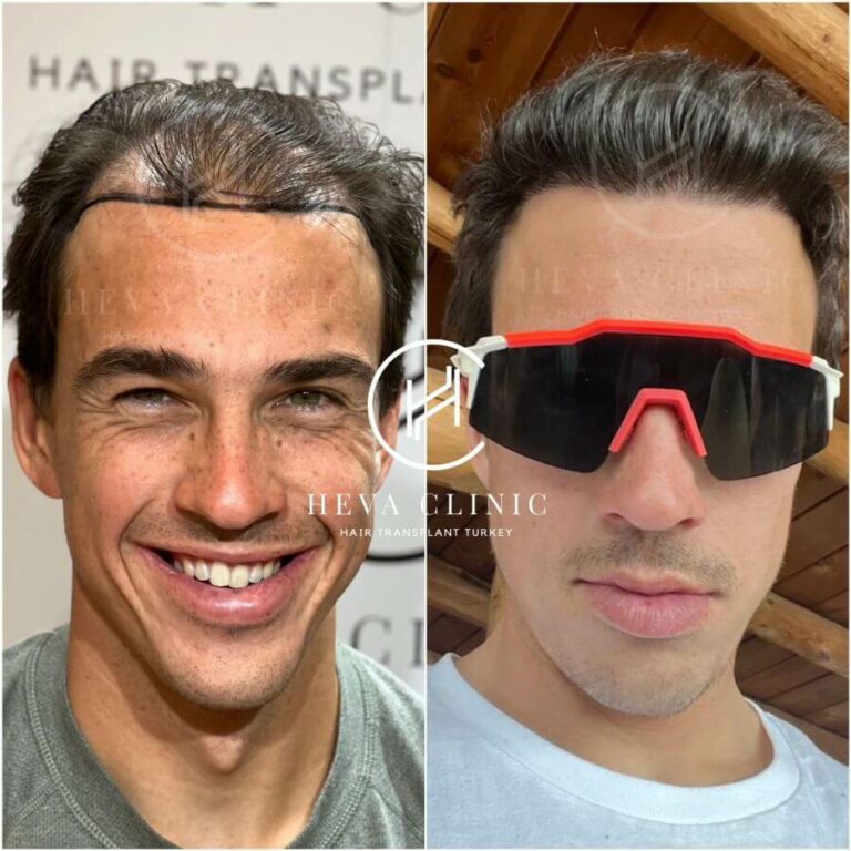 20 Best Men’s Haircuts for Balding Hair - How To Hide Your Hair Loss