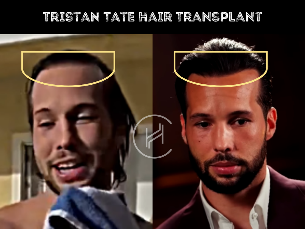 Tristan Tate Hair Transplant - Hair Loss & Technical Analysis Tristan Tate Hair Transplant - Hair Loss & Technical Analysis