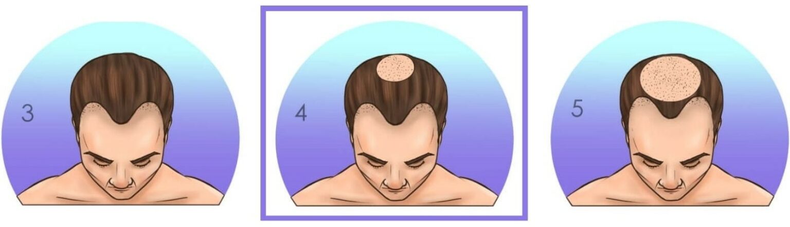 Norwood Scale 4 Hair Transplant - 2026 Costs and Medical Process - Heva ...