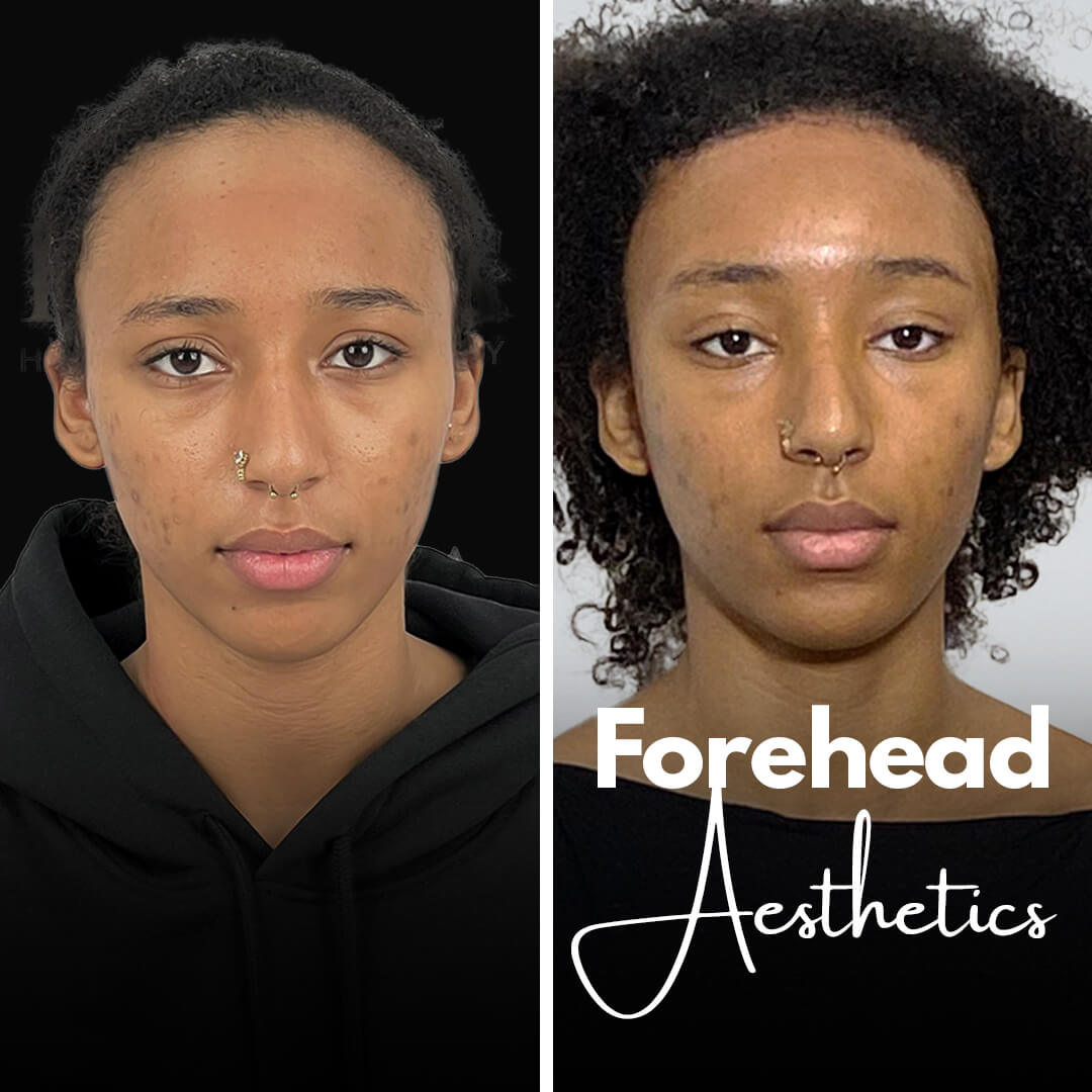 Forehead Reduction Before & After Photos - Unfiltered Results
