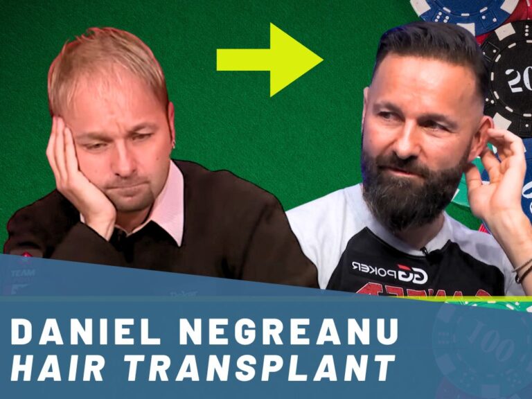 Daniel Negreanu Hair Transplant - Hair Loss & Technical Analysis