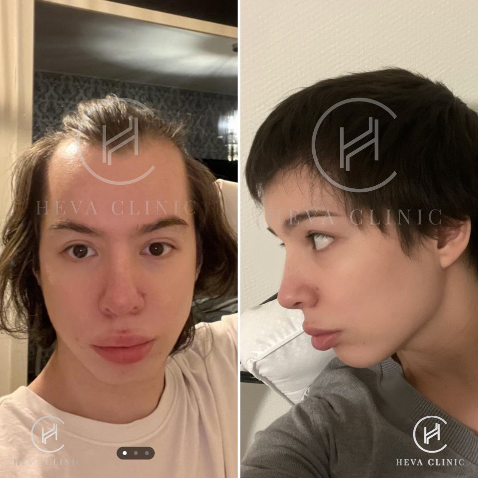 MTF Transgender Hair Transplant - Process and Costs in 2025