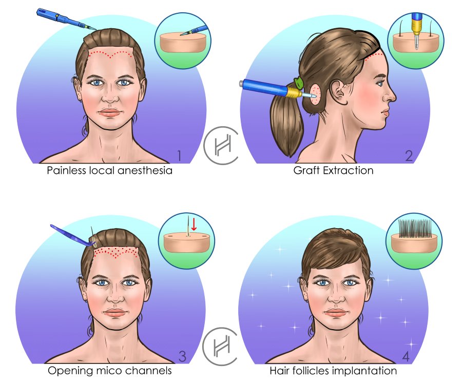MTF Transgender Hair Transplant - Process and Costs in 2025