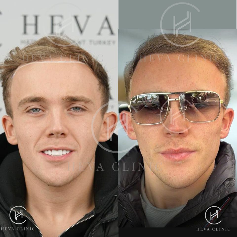 1000 Grafts Hair Transplant - Operation and Costs in 2026